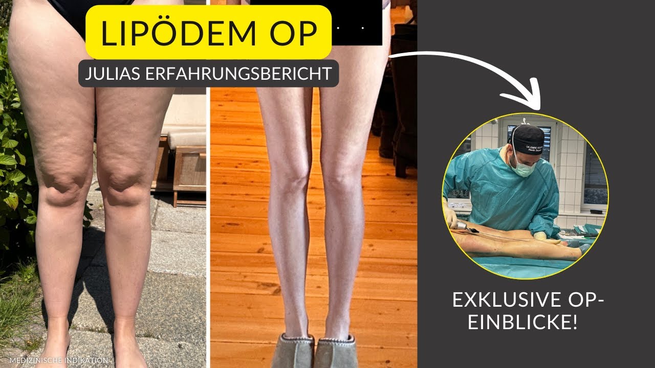 Lipödem-OP Erfahrung: Beratung, OP & Ergebnis nach 3 Monaten ...