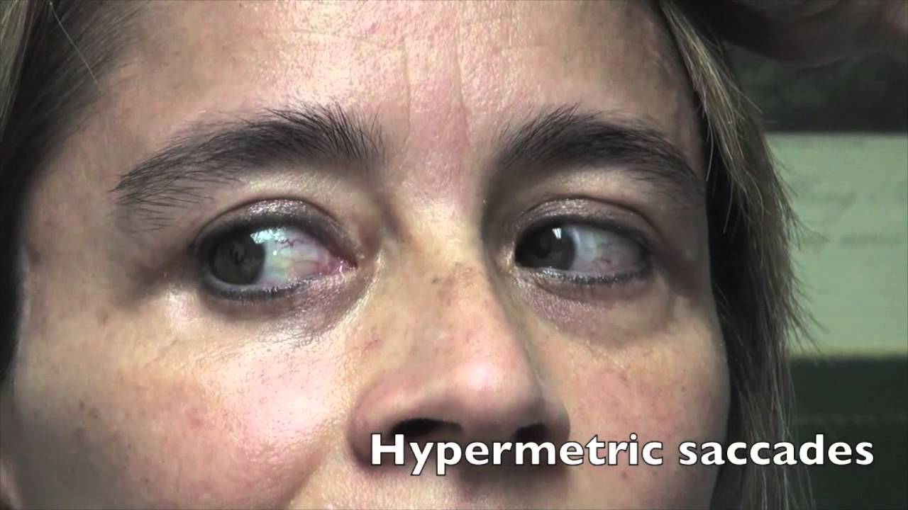 Case Challenge: The patient had hypermetric saccades. (Video 1) - YouTube