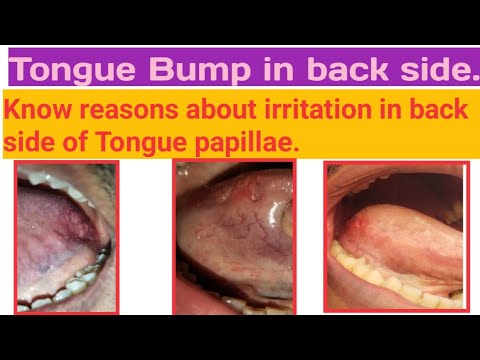 Tongue bump.Tongue papillae increase in size.Burning sensation in side ...