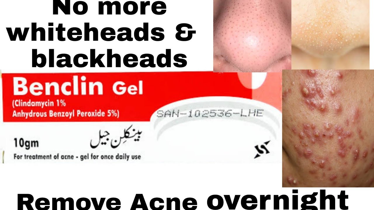Benclin Gel review || Acne ,pimples whitehead & Blackhead remove ...
