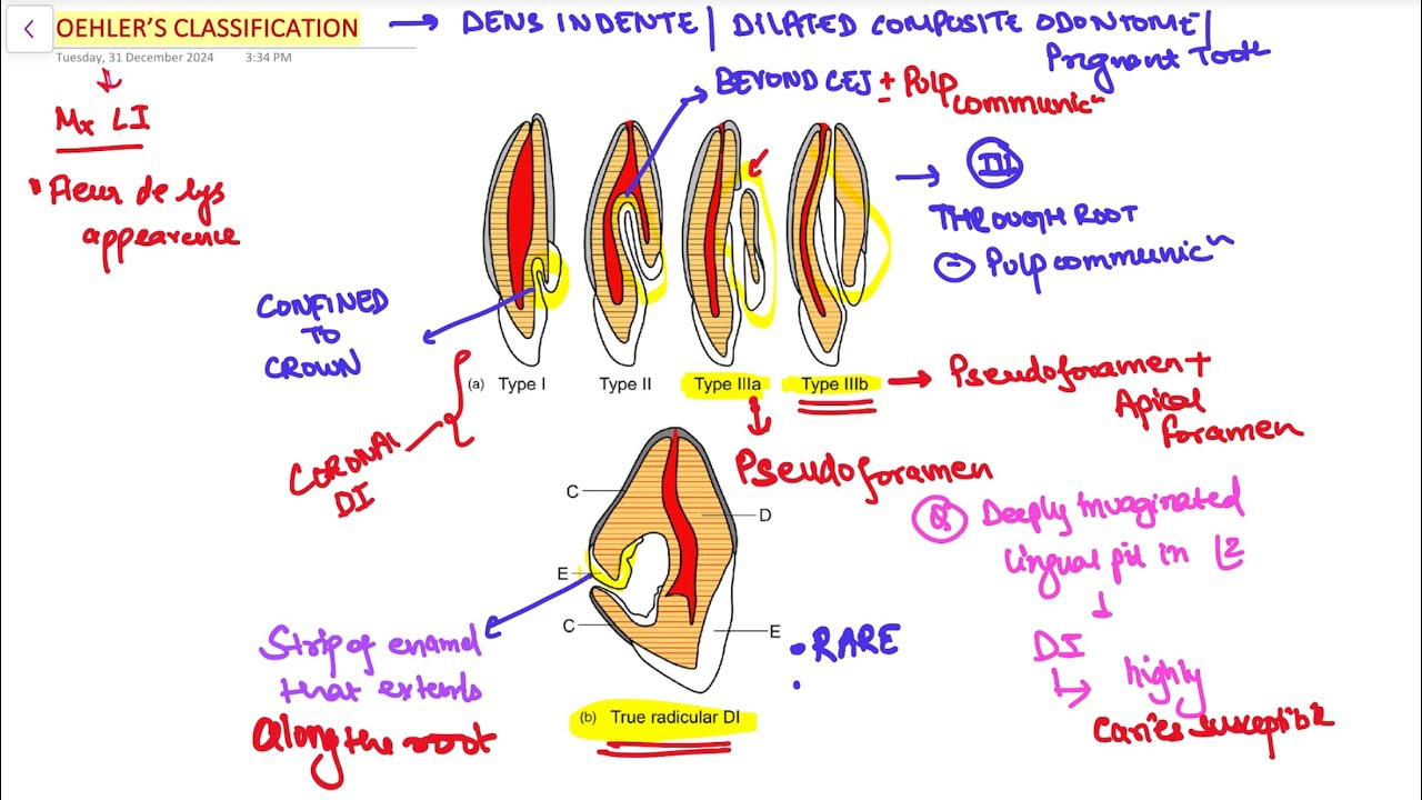 Oehlers Classification of Dens In Dente ORAL PATHOLOGY - YouTube