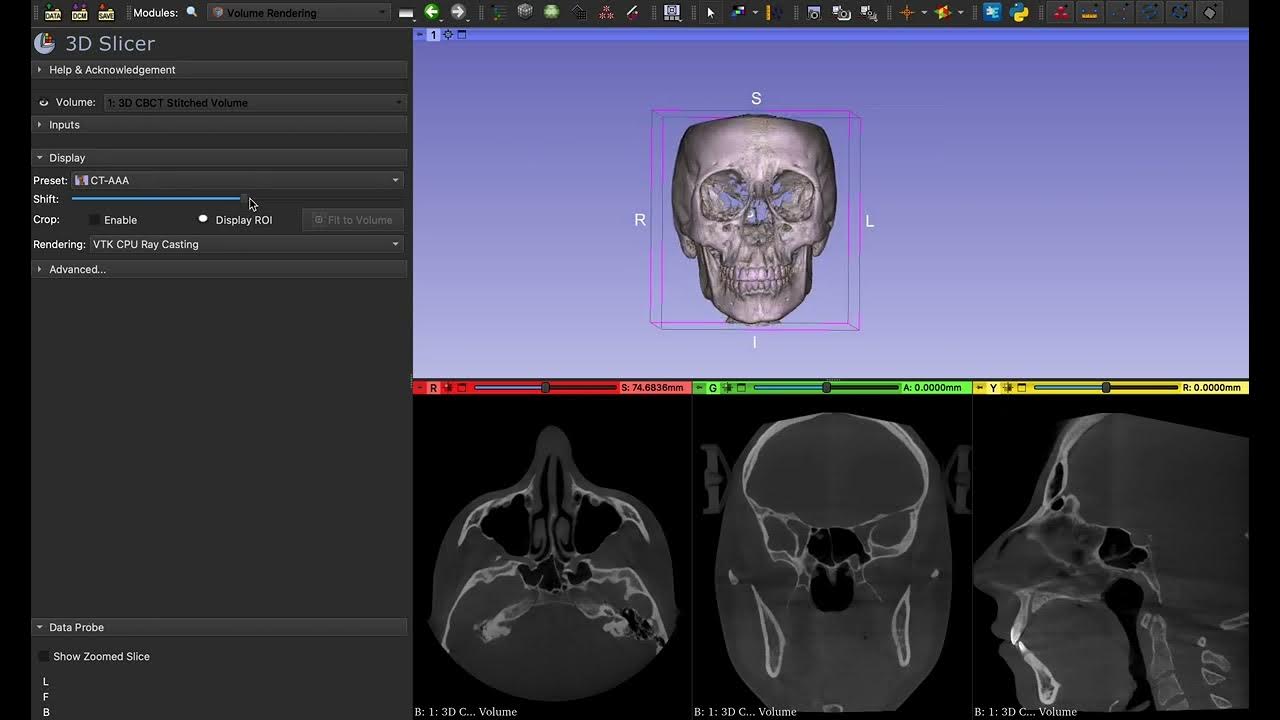 Ver y analizar tomografías con 3D Slicer (software gratuito) - YouTube