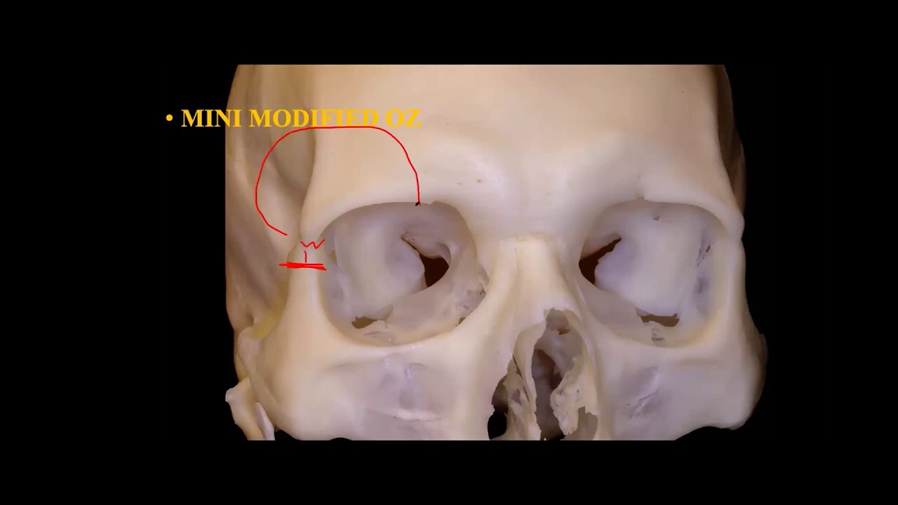Orbitozygomatic Approach - Microsurgical Anatomy - Part 2 - YouTube