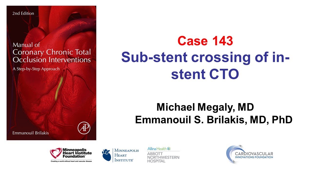 Case 143: Manual of CTO PCI - Sub stent crossing - YouTube