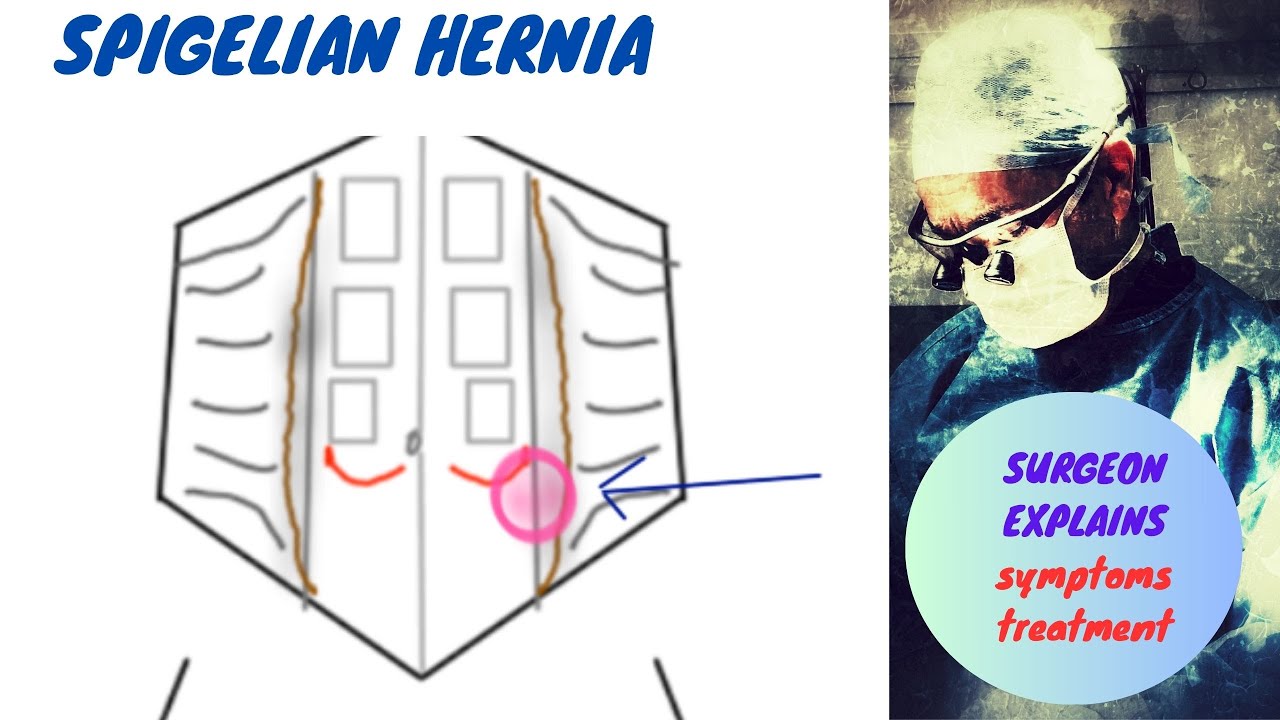 Spigelian Hernia Pronunciation