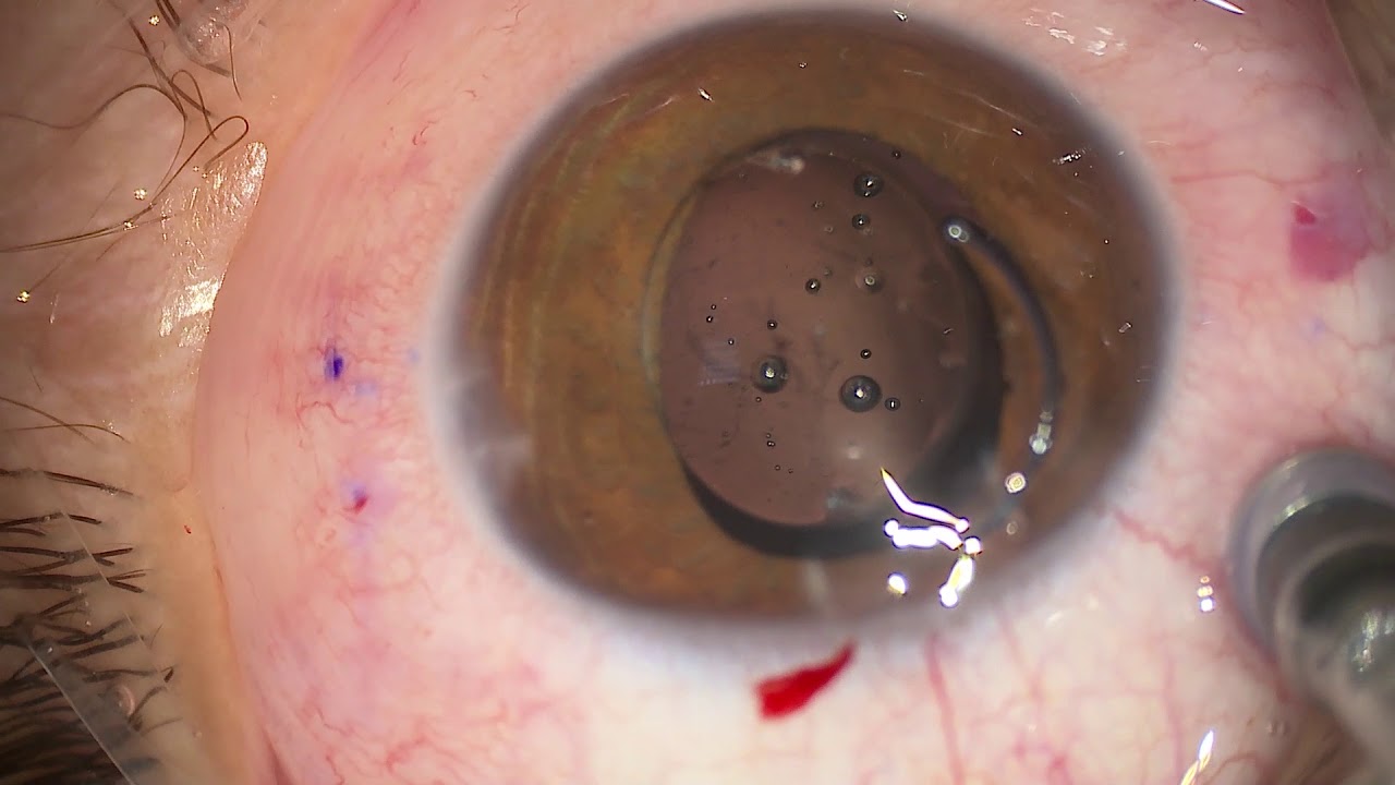 Pars Plana Lensectomy & Yamane Double Needle IOL Implantation (with an ...