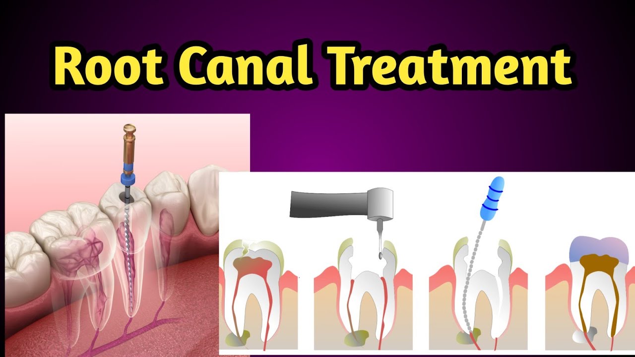 How Root Canal Treatment for Teeth is Done ? - YouTube