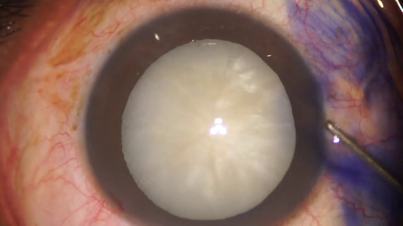 White Cataract + Soft Nucleus - Dr Ramakrishna Tadanki - YouTube