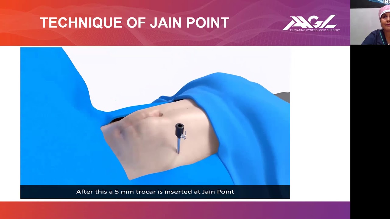 Jain Point: Laparoscopic Entry in Thin Patients - YouTube