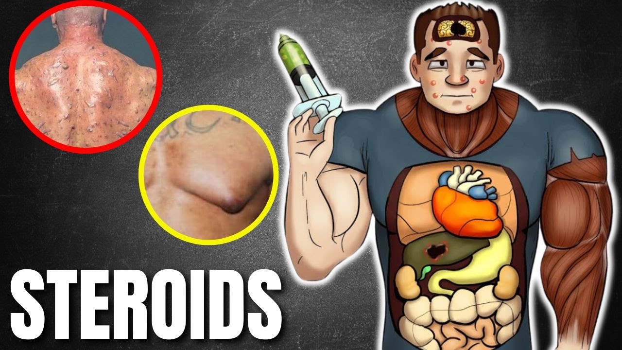 5 signs that someone is taking high risk steroids BASED ON SCIENCE ...