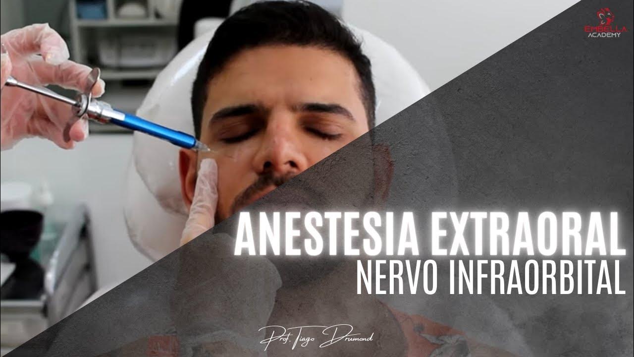 Anestesia Extraoral Nervo Infraorbital Youtube