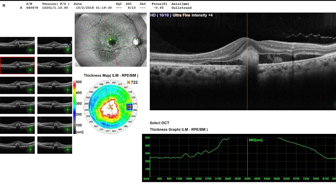 Clinical applications of OCT in macular diseases (compilation video ...