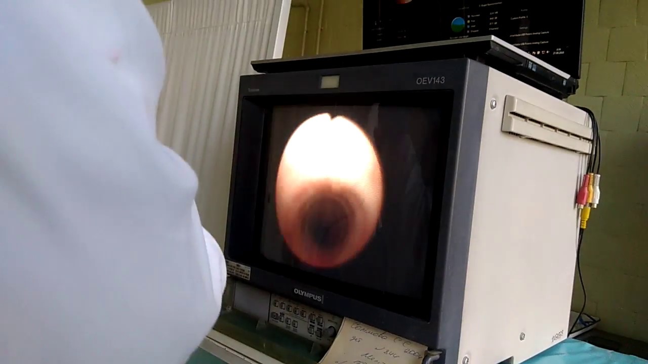 Diagnostic Fiberoptic Bronchoscopy in suspected smear of Tuberculosis ...