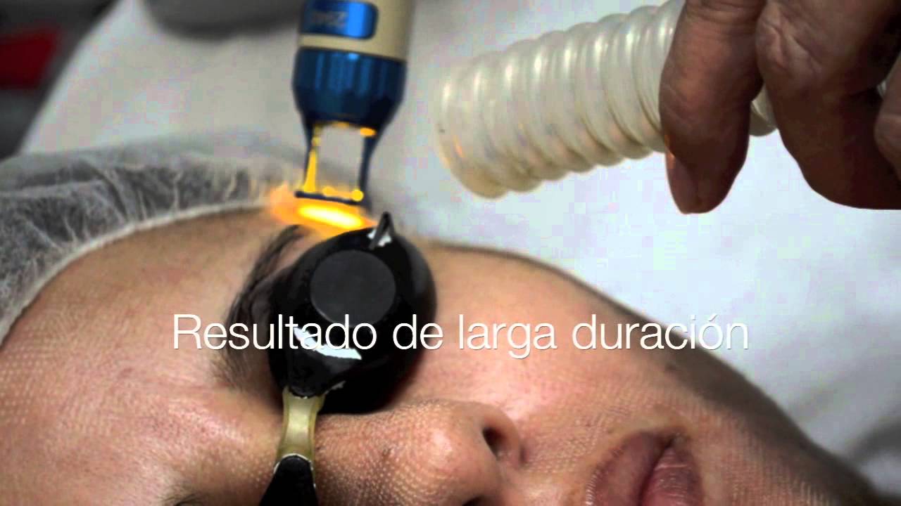 Procedimiento Tecnología Pixel 2940 Er:YAG - YouTube