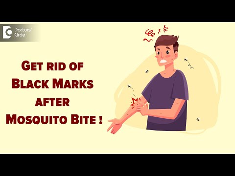 MOSQUITO BITE MARKS | How to treat black marks after mosquito bite?-Dr. Nischal K  | Doctors' Circle