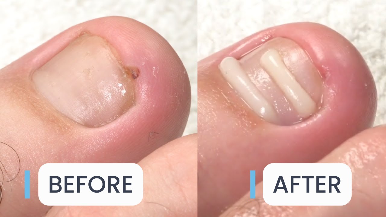 Ingrown Toenail Treatment - PAIN FREE! - YouTube