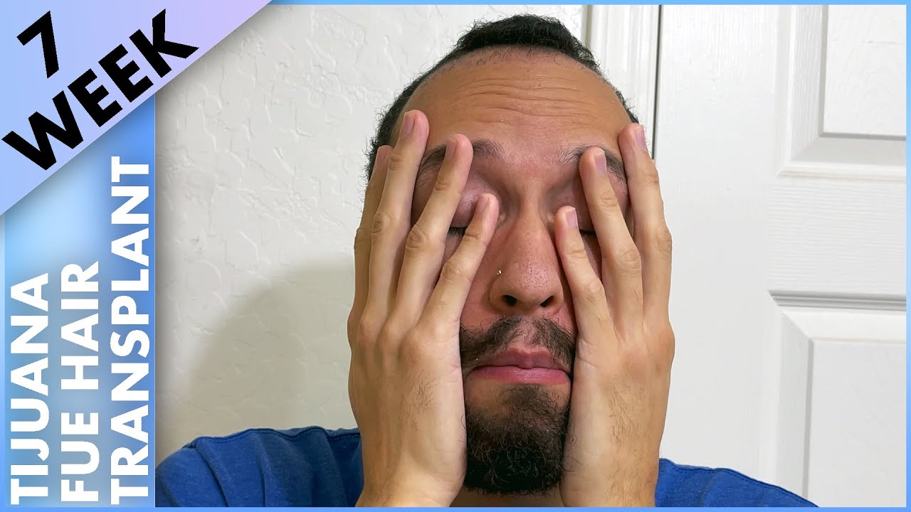 Week 7 | FUE Hair Transplant In Tijuana | Biracial Black Afro Hair ...