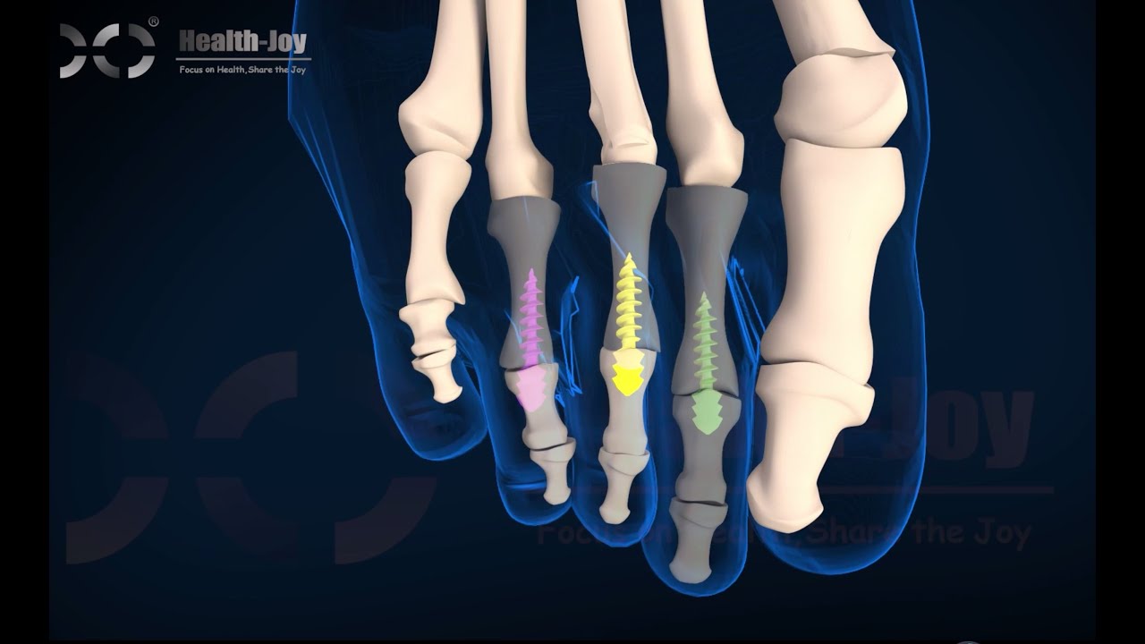 Cheveron Osteotomy,Scarf Osteotomy, Weil Osteotomy, Hammertoe ...