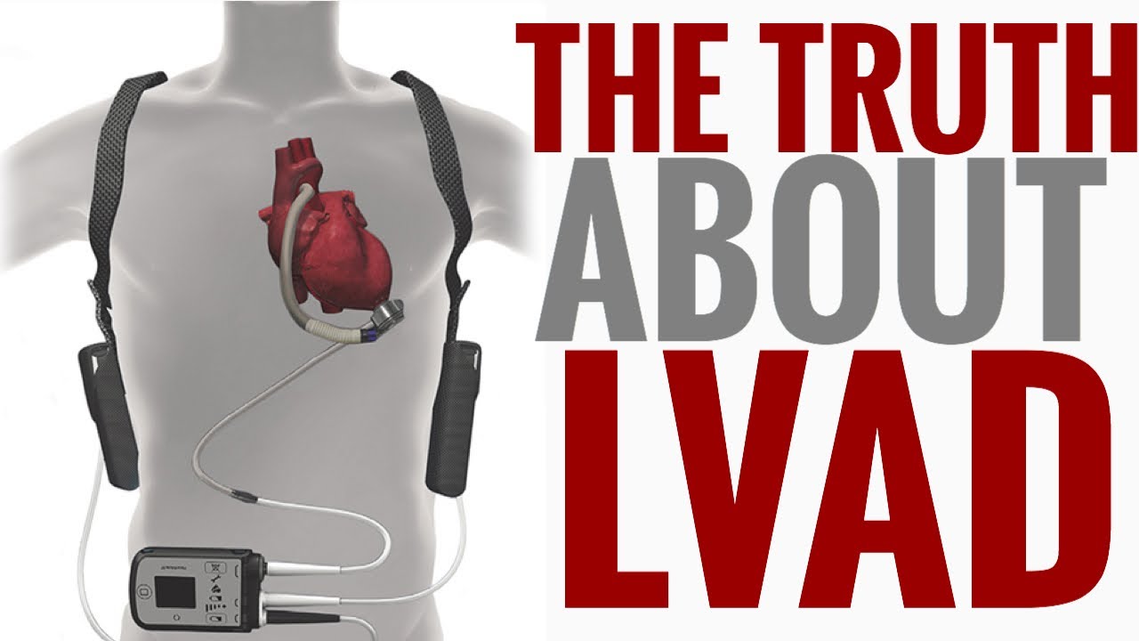 LVAD IS A LIFE SAVER!!!! - YouTube