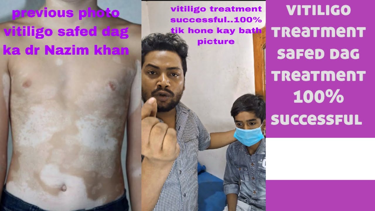 safed dag ka treatment 100% successful real | #vitiligotreatment India ...