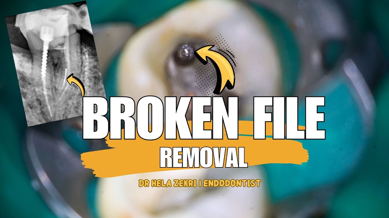 How to remove separated instruments from the middle third of the canal ...