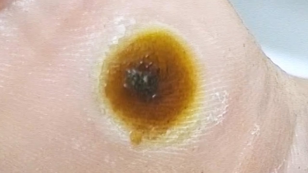 Extremely comfortable corn treatment process, super decompression # ...