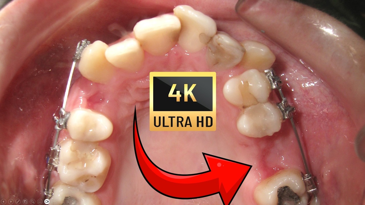 Ectopic canines in ADULTS and WISDOM tooth eruption! Braces time lapse ...
