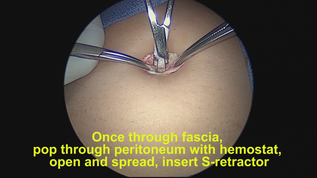 Open Hasson Abdominal Entry YouTube open-hasson-abdominal-entry-youtube