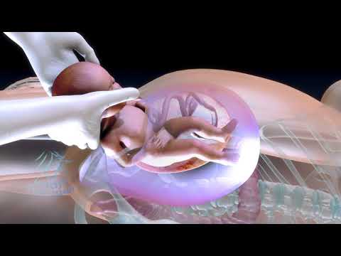 Caesarean operation animation