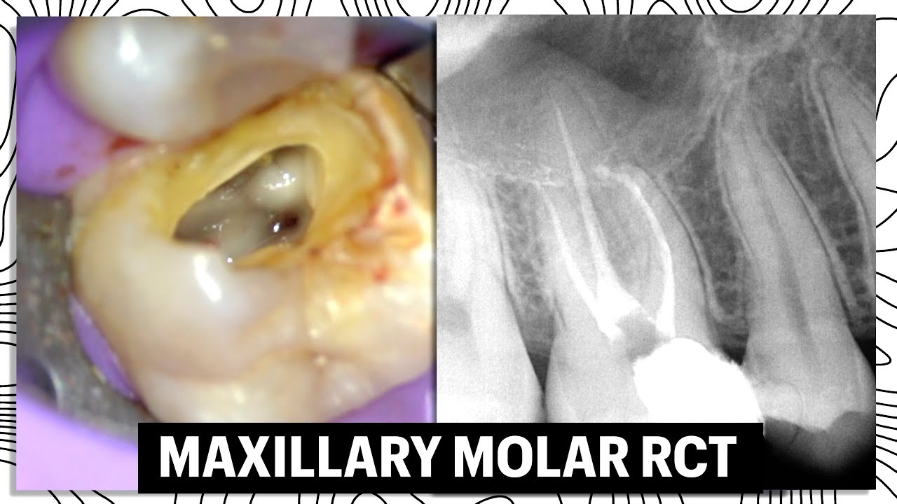 LIVE Maxillary Endodontics w/ MB2 | Mesial Molar Access (FULL LENGTH ...