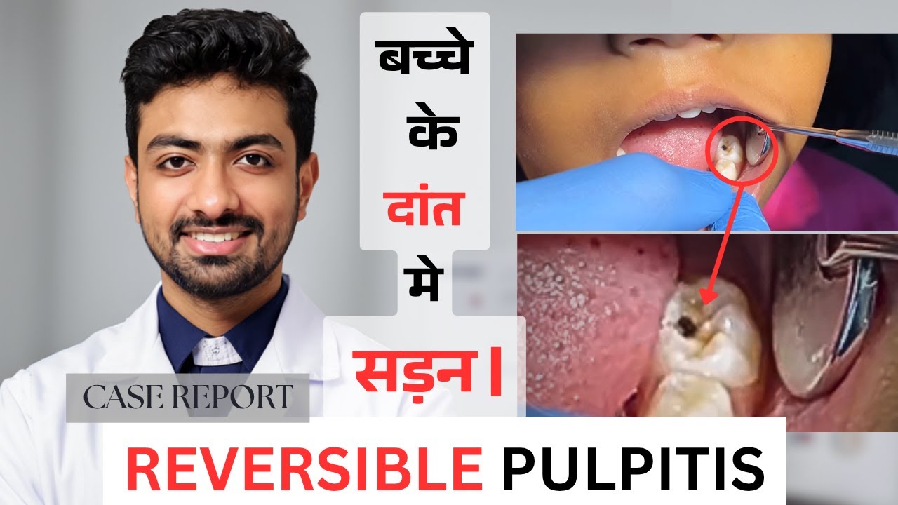 Case of Cavities (Reversible pulpitis) in Pediatric Patient. | With ...