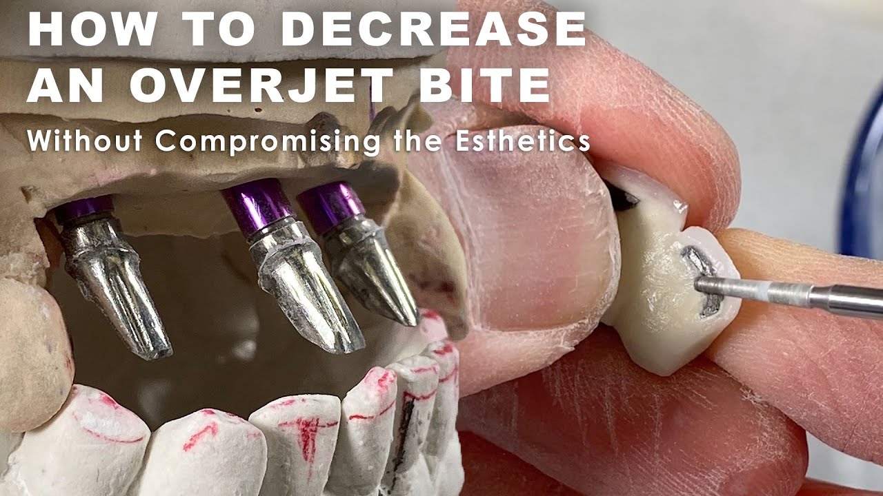 How to Decrease an Overjet Bite without Compromising the Esthetics ...