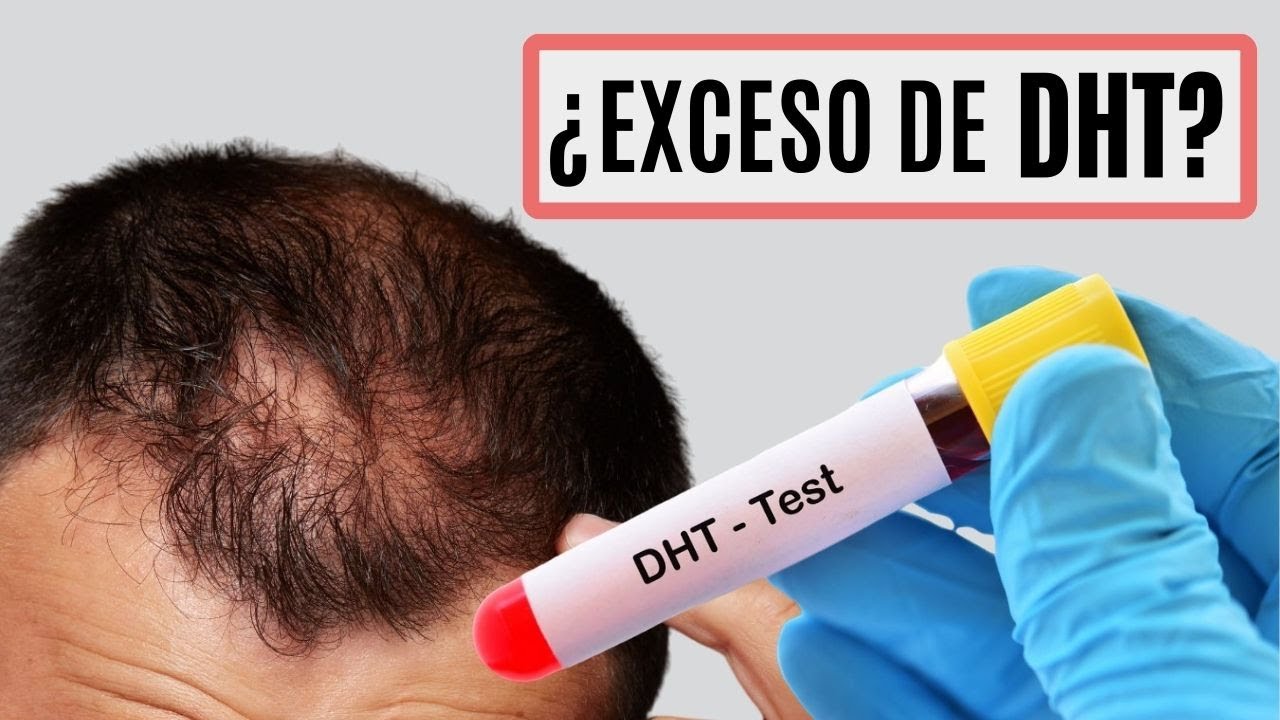 ALOPECIA causada por DHT 👉 Dihidrotestosterona y la CALVICIE - YouTube