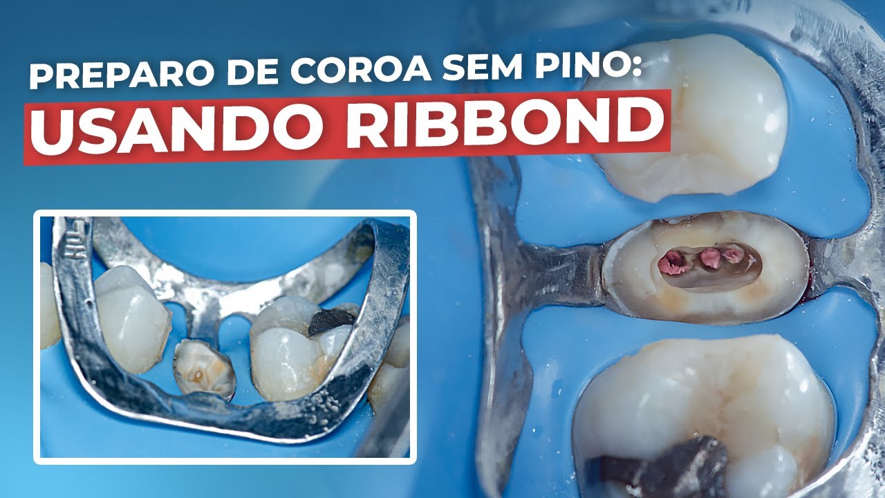 PREPARO DE COROA SEM PINO: USANDO RIBBOND - Mylene e Renato - YouTube
