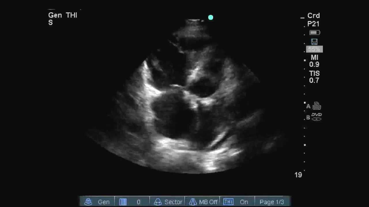 Right Ventricular enlargement (chronic) on Echo Apical 4 chamber view ...