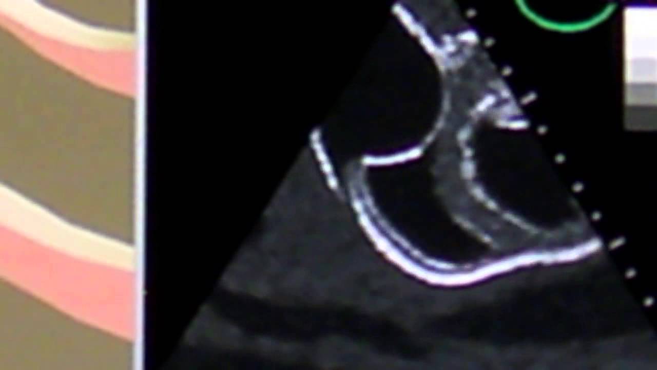 transesophageal echocardiography procedure (TEE) transgastric - YouTube