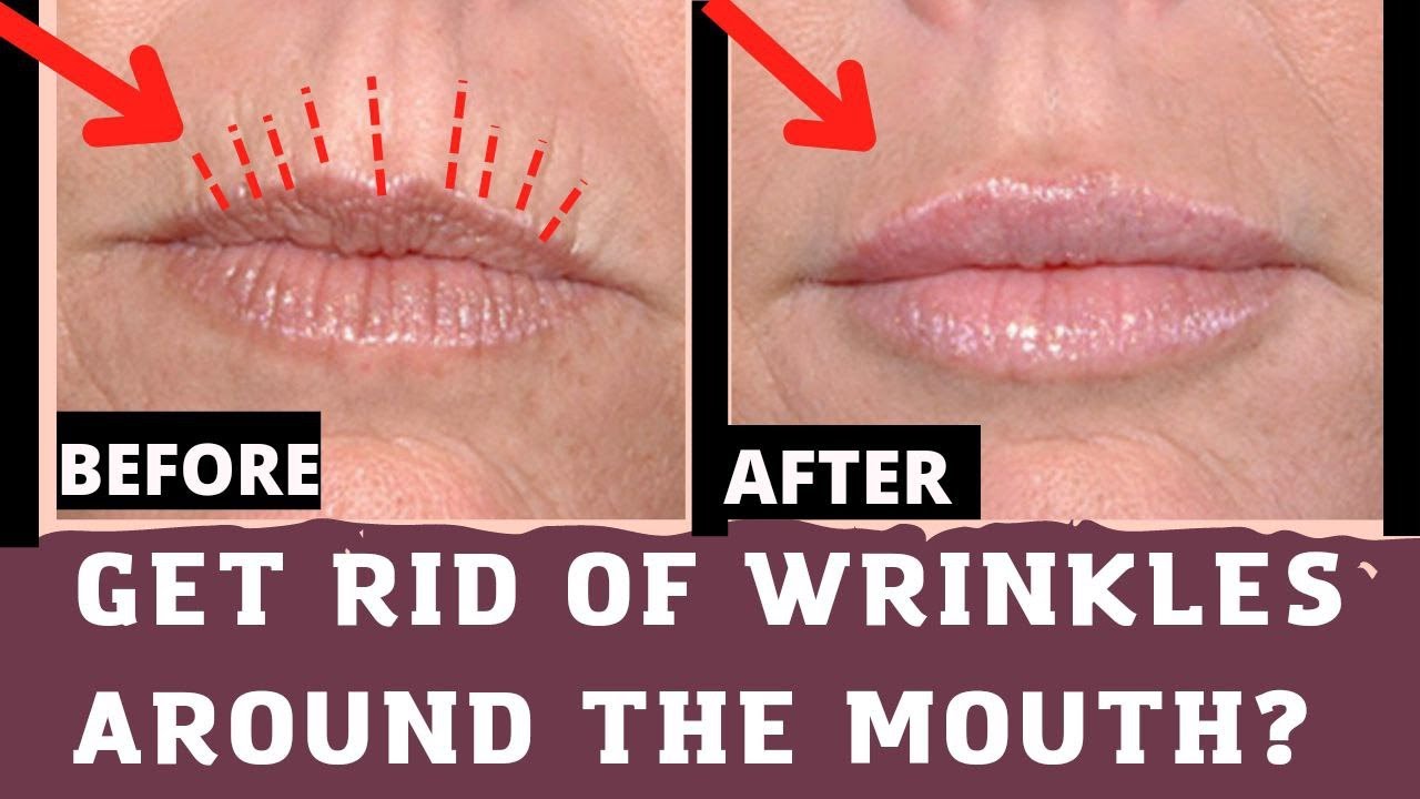 How to Get Rid of Wrinkles around the Mouth ?|Mouth Lines| upper lip ...
