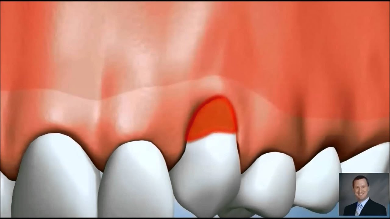Exposed Tooth Root Dentist Pasadena Texas YouTube Exposed Tooth Root Dentist Pasadena Texas YouTube