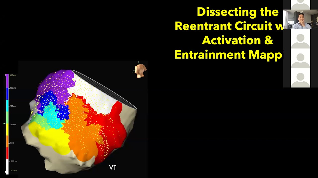 Virtual EP Fellows Conference 4 3 20 Rod Tung VT entrainment - YouTube