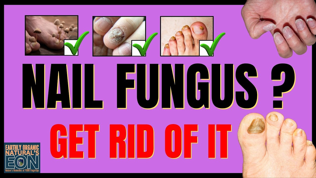Get rid of NAIL FUNGUS fast and effectively - YouTube