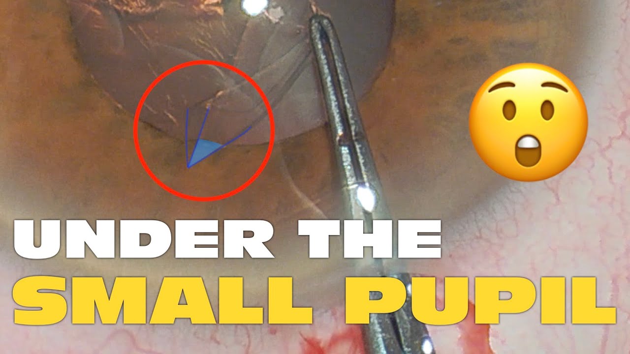 Phaco Clip #213 - Under The Small Pupil Rhexis - YouTube
