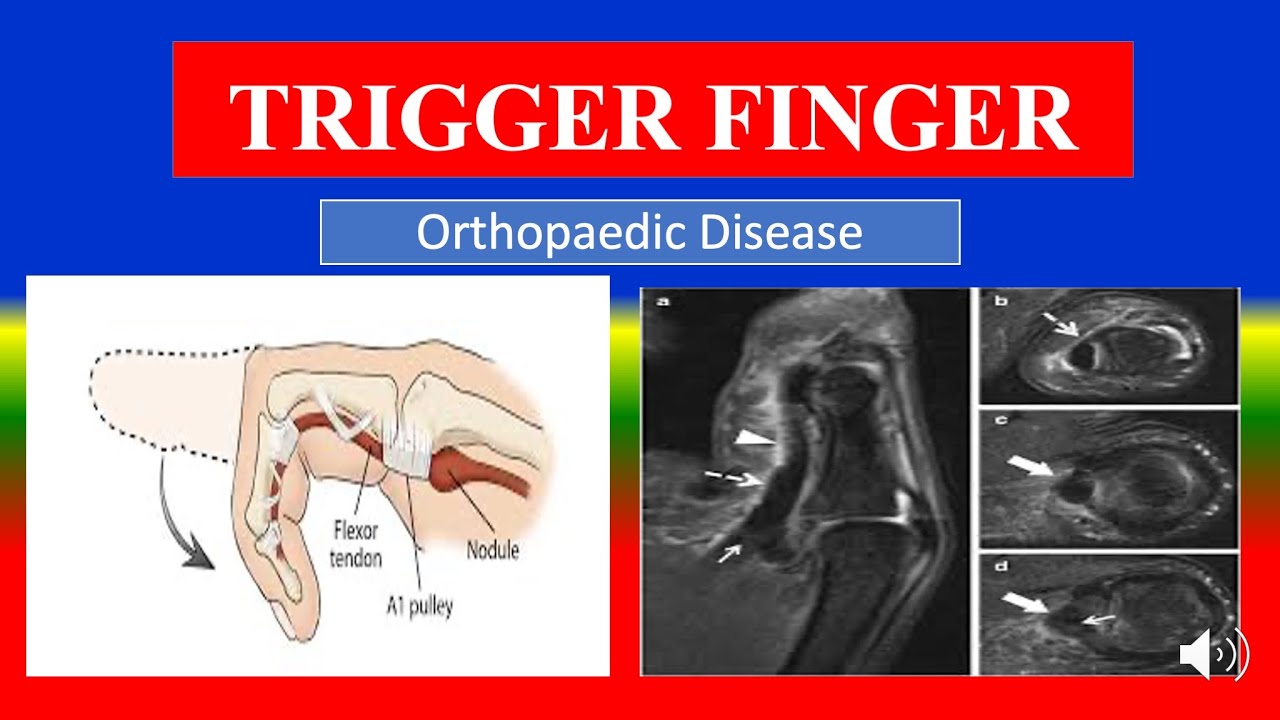 TRIGGER FINGER - Definition, types, causes, pathophysiology, symptoms , diagnoses , medicine ...