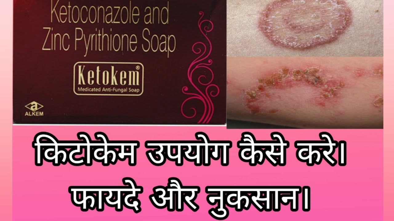 Ketokem Soap & Ketokem CT Soap - Detailed Product Review in Hindi - YouTube