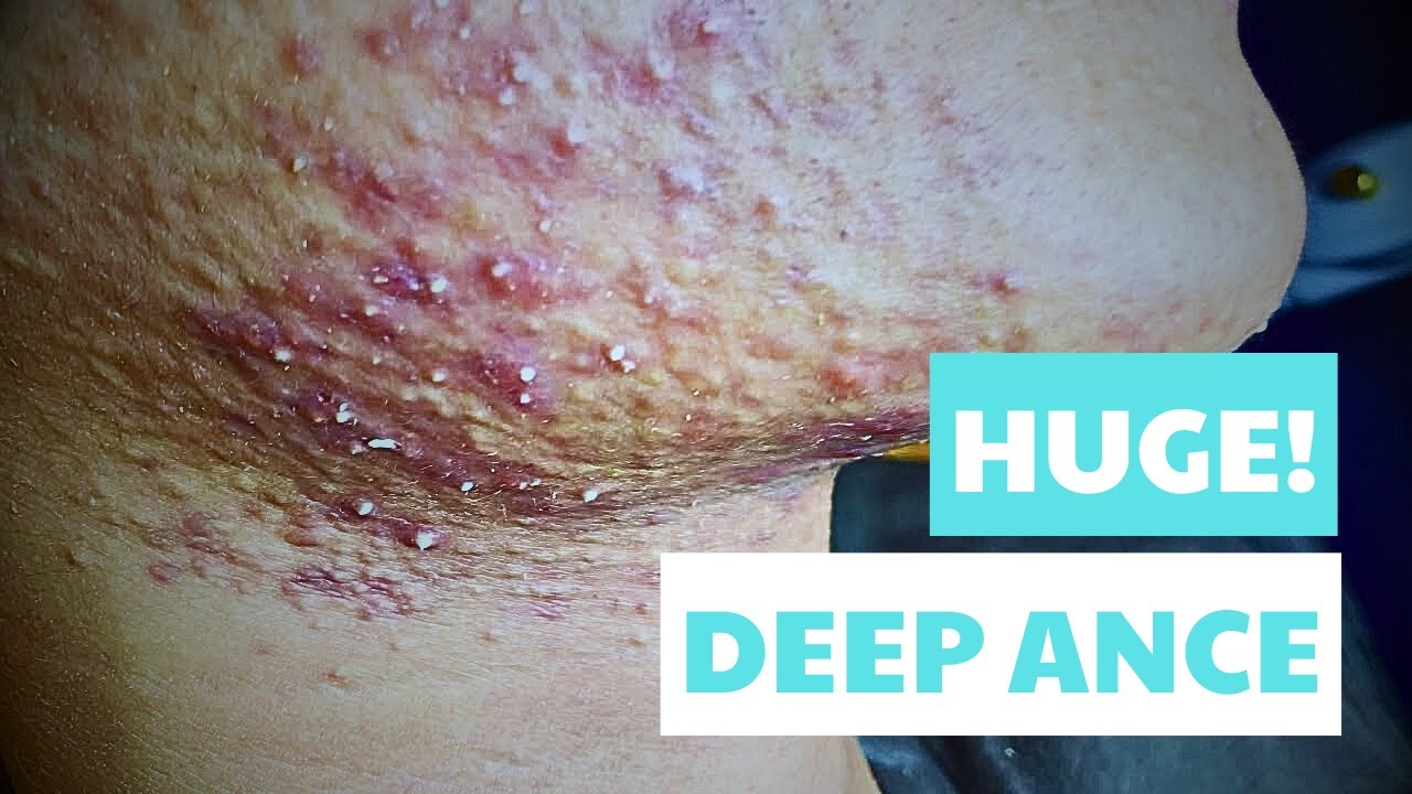 HUGE PIMPLE POPPING 😱 Deep Acne Removal | Nặn Mụn Khổng Lồ Cực Đã - Spa ...