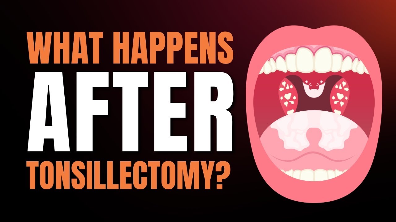 Tonsillectomy Recovery - What To Expect After Surgery? - YouTube