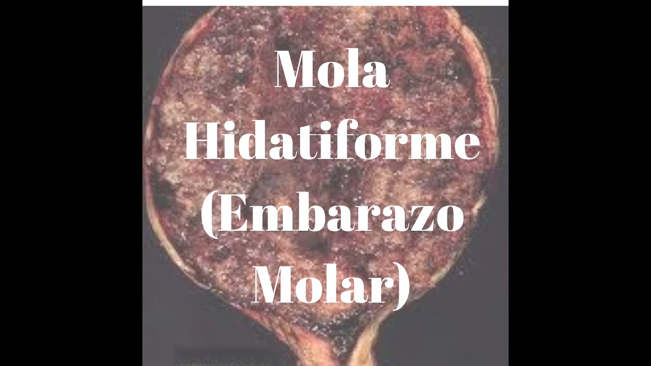 Enfermedad trofoblástica/ mola hidatiforme/ mola parcial/ mola completa ...