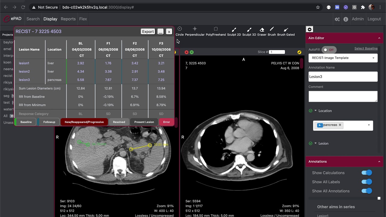 Demo of ePAD's annotation and reporting capabilities - YouTube