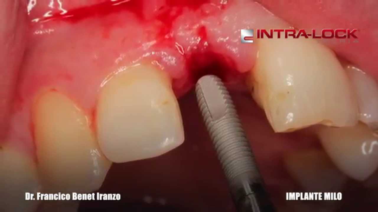 Caso Benet Intra lock Milo - YouTube