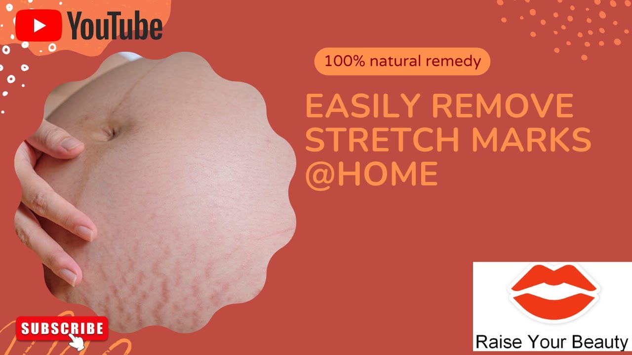 How to Reduce Body Stretch Marks| Home made remedy|Raise Beauty - YouTube