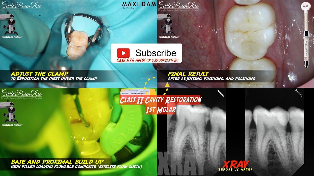 RUBBER DAM PLACEMENT PROCEDURE MANDIBLE, CLASS 2 RESTORATION COMPOSITE ...